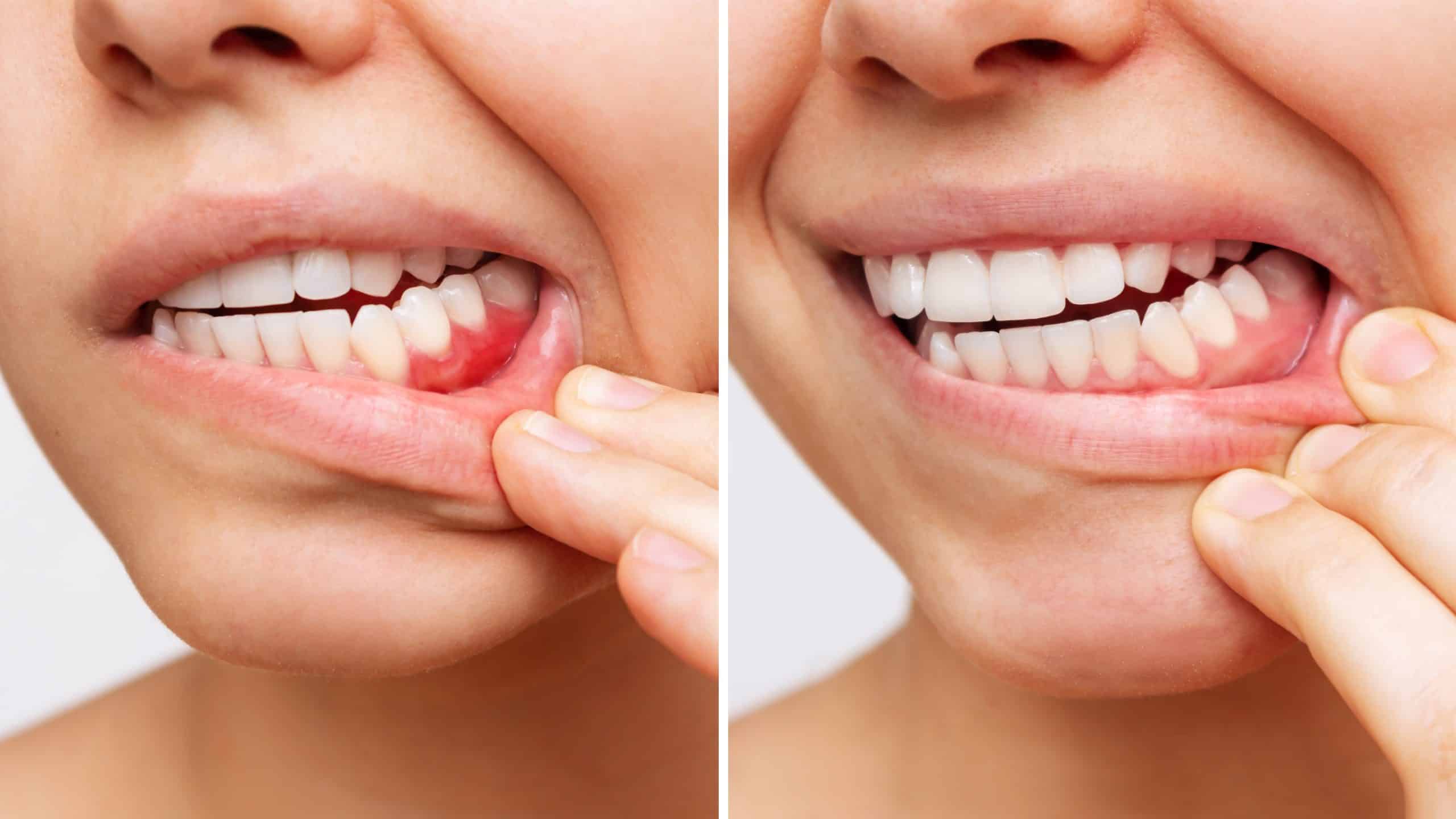 Gingivitis vs. Periodontitis: Understanding Your Oral Health